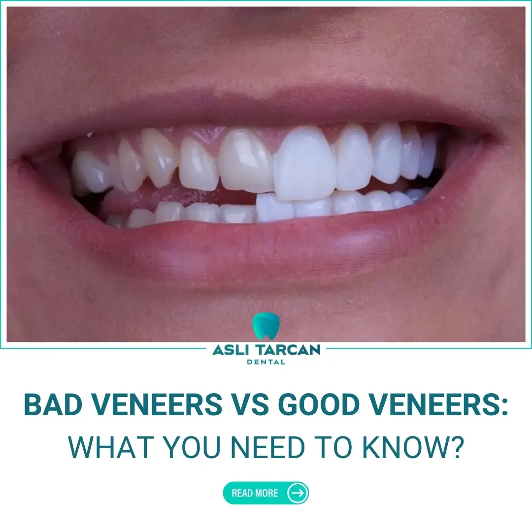 Bad Veneers vs Good Veneers: What You Need to Know?