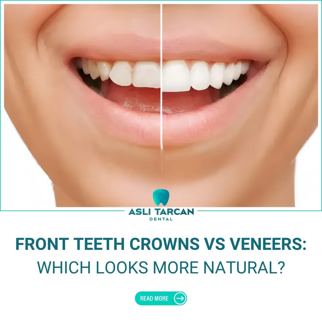 Front Teeth Crowns vs Veneers - Which Looks More Natural?