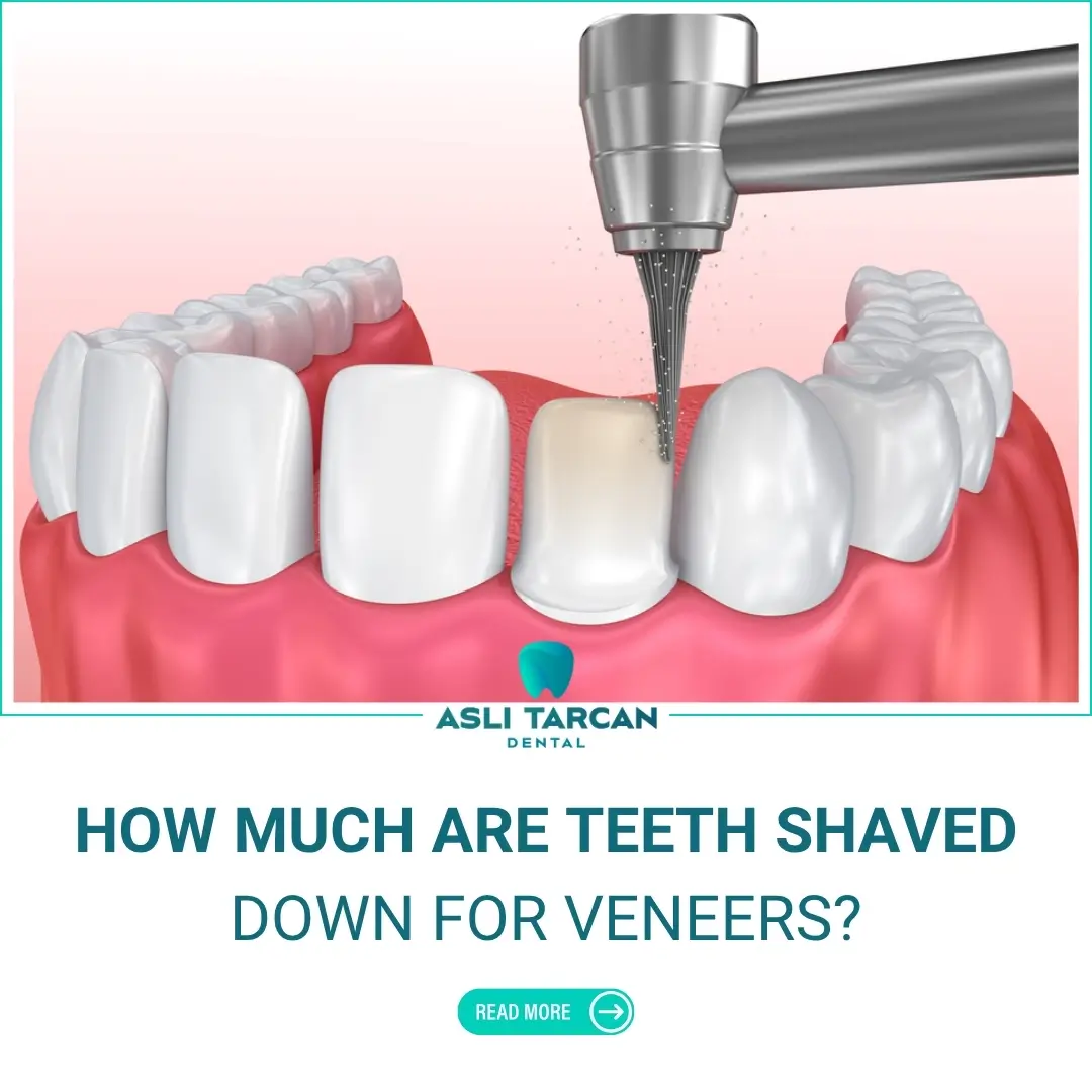 How Much Are Teeth Shaved Down For Veneers?