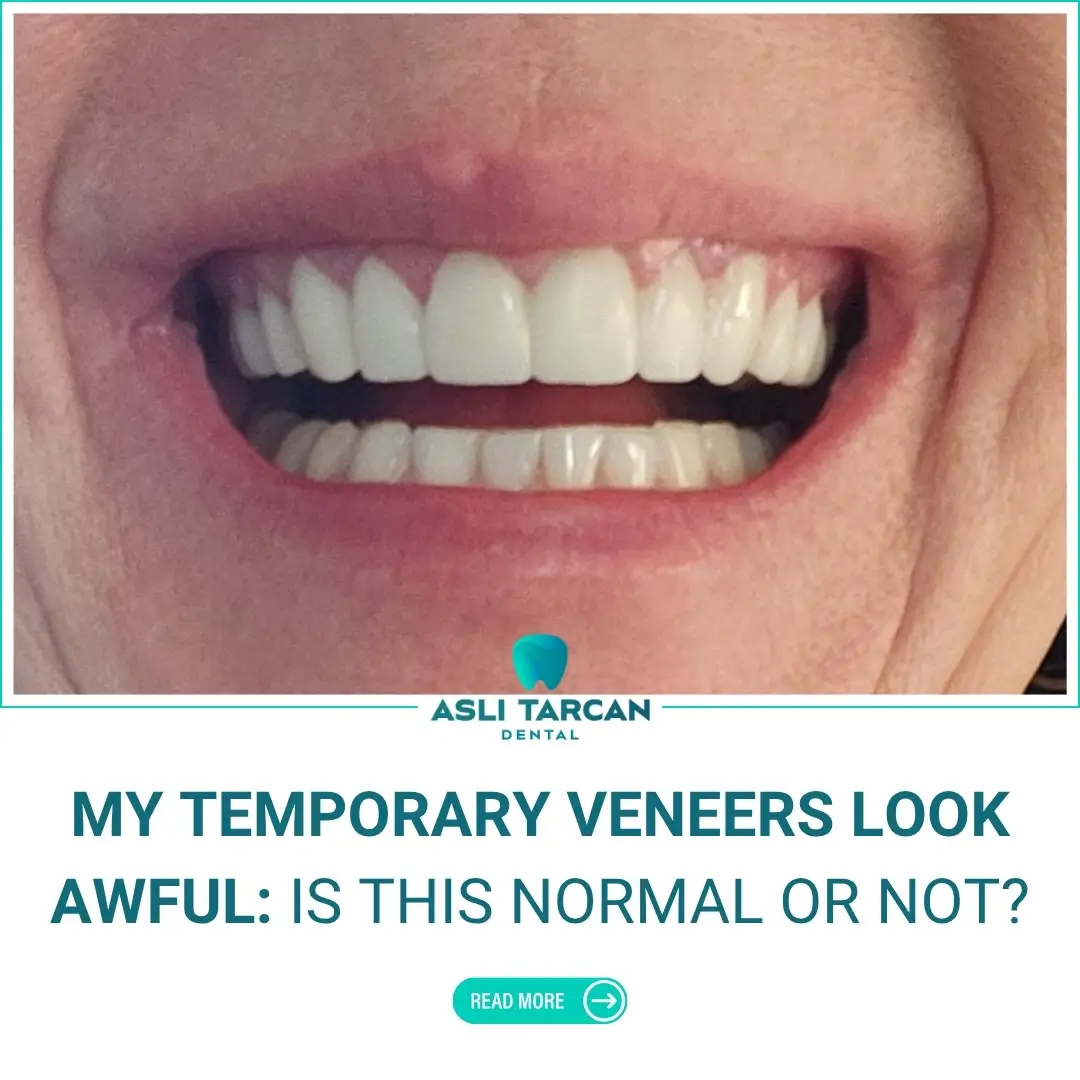My Temporary Veneers Look Awful: Is This Normal or Not?