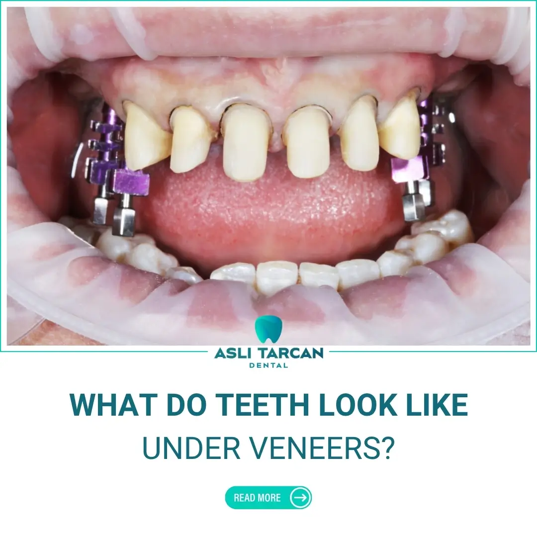 What Do Teeth Look Like Under Veneers?